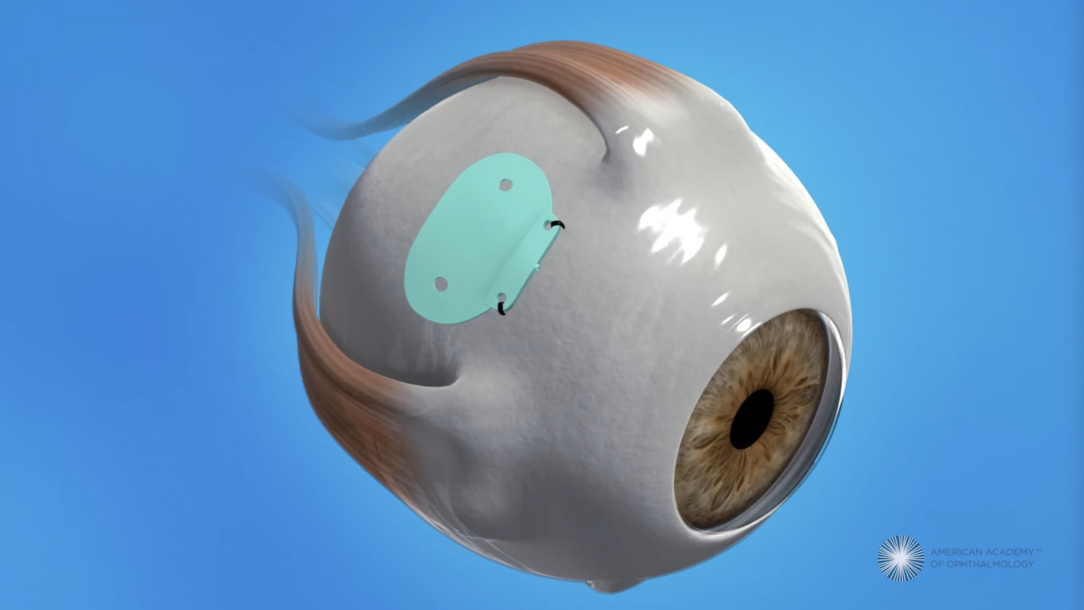 Traditional Glaucoma Surgery in Michigan | Glaucoma Southfield