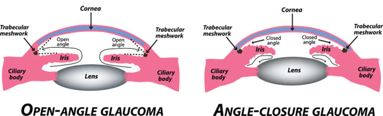 Glaucoma Michigan | What is Glaucoma? | Glaucoma Center